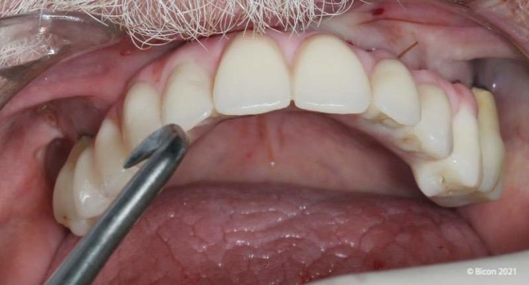 16. Uso del instrumental extractor de coronas para retirar la prótesis ...