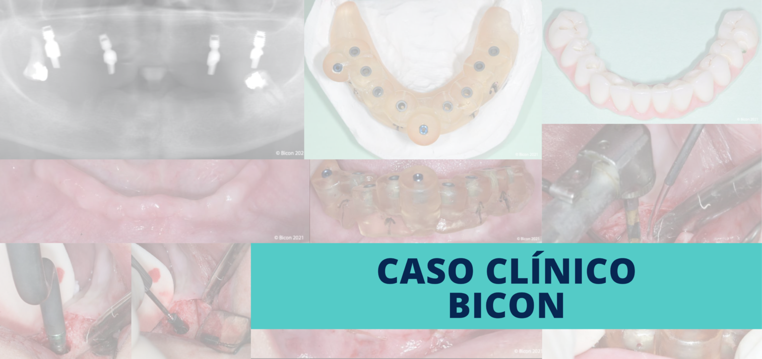 Colocación y carga inmediata con prótesis TRINIA | Dental Tonal