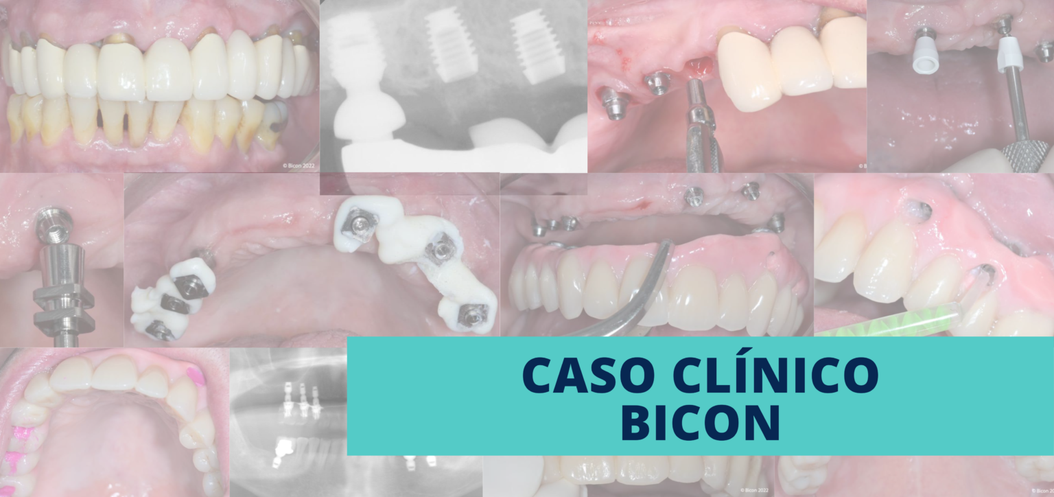 Reemplazo de una prótesis TRINIA y colocación de seis implantes Bicon ...